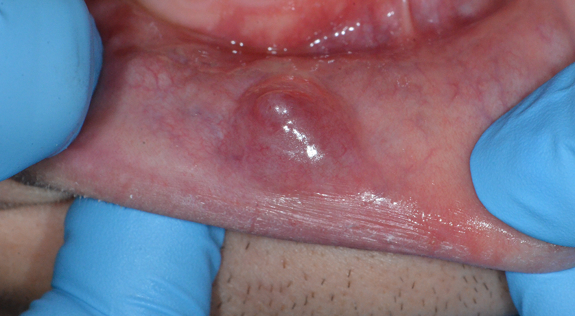 Mucocele Removal in Los Angeles | Safe, Quick Treatment